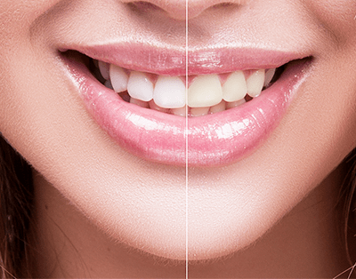 Teeth Whitening - One & Only Dental | Dentist in Old Harlow & Loughton ...